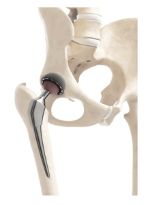 Heupklachten | Ortho Direct